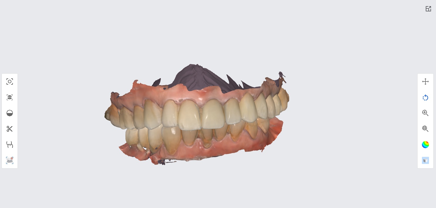 Intraoral Scanner | Dentist in Houston, TX